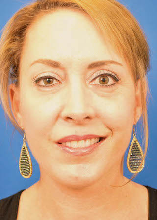Bell's Palsy Before & After - Facial Paralysis Photo Gallery | FPI