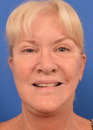 Bell's Palsy Before & After - Facial Paralysis Photo Gallery | FPI