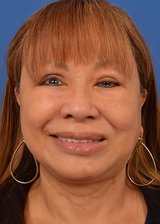 Bell's Palsy Before & After - Facial Paralysis Photo Gallery | FPI