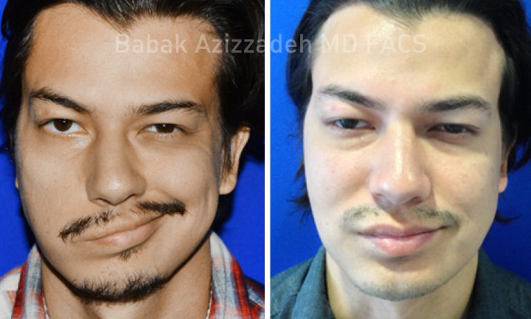 Masseter to Trigeminal Facial Nerve Transfer - Dr. Azizzadeh | FPI