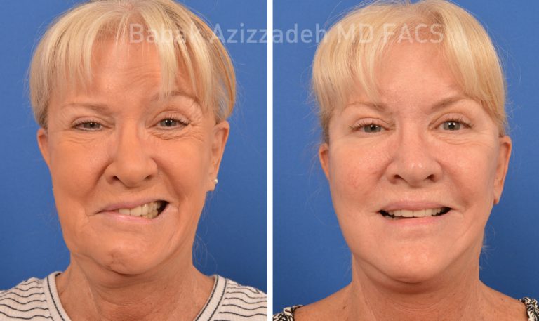 Synkinesis - Facial Synkinesis Symptoms & Treatment