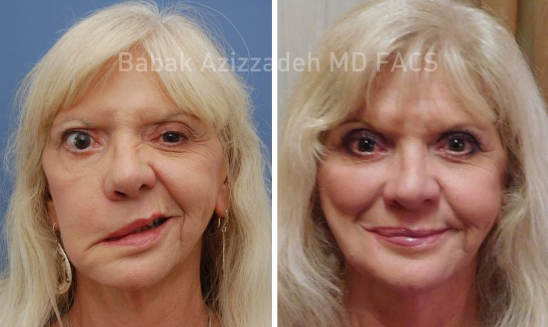 Masseter to Trigeminal Facial Nerve Transfer - Dr. Azizzadeh | FPI