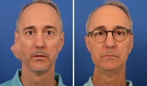 Parotidectomy Surgery - Parotid Gland Surgery