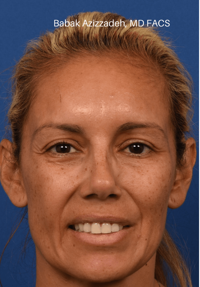 Bell's Palsy Before & After - Facial Paralysis Photo Gallery | FPI