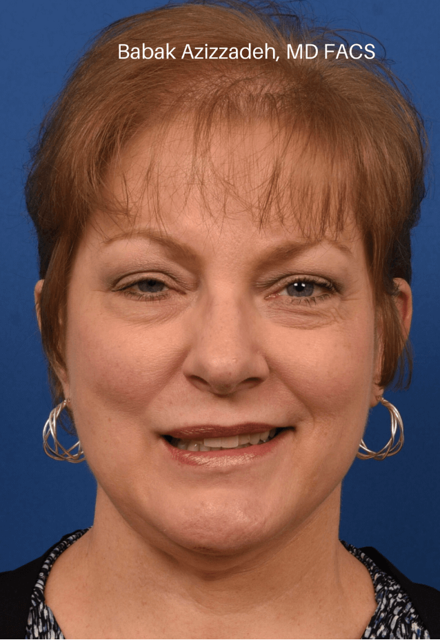 Bell's Palsy Before & After - Facial Paralysis Photo Gallery | FPI