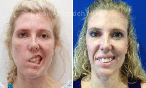 Reanimation Surgery for Facial Paralysis | Facial Paralysis Institute