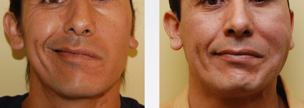 Common Nerve Damage Treatments | Facial Paralysis Institute