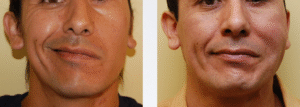 Common Nerve Damage Treatments | Facial Paralysis Institute