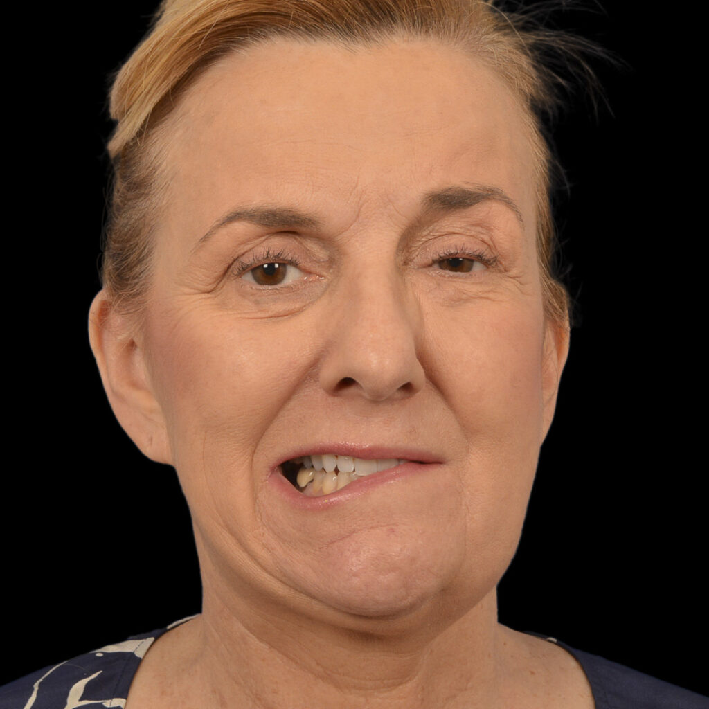 Bell's Palsy Before & After - Facial Paralysis Photo Gallery | FPI