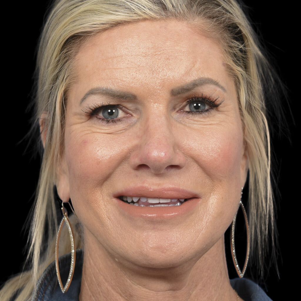 Bell's Palsy Before & After - Facial Paralysis Photo Gallery | FPI